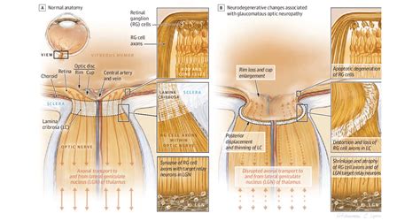 How Does Optic Nerve Ganglion Cell Damage Occur Glaucoma Australia