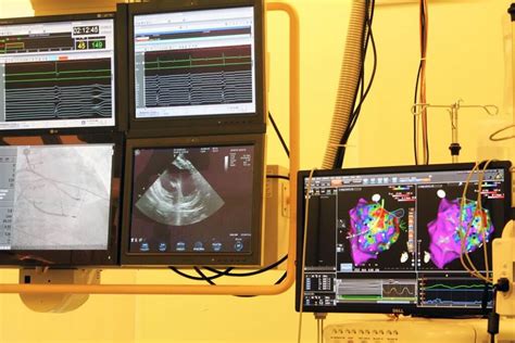 Treatment Of Sinus Bradycardia Methods Treatment Of Sinus Bradycardia