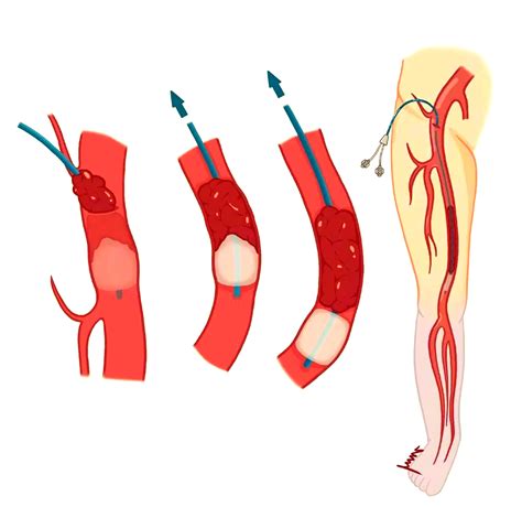 Cirurgia Intervencionista Minimamente Invasiva Com Sistemas De Imagem