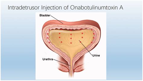 Distribution Of The Injection Points Of Botulinum Toxin A Download
