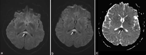 The Diffusion Weighted Imaging A And B And Apparent Diffusion Download Scientific Diagram