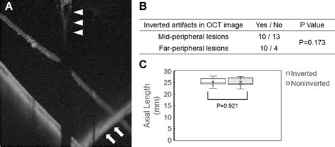 Figure 2 From Ultra Widefield Swept Source Optical Coherence Tomography Findings Of Peripheral