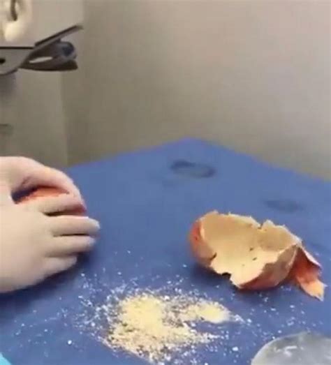 30 Yıllık Bir Meme İmplantındaki Kireçlenmeyi Gösteren Doktor Yeni Fobi