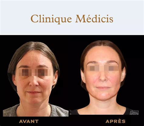 PRX-T33 light peel Paris Dr Abbou and Dr Pessis Plastic Surgeons