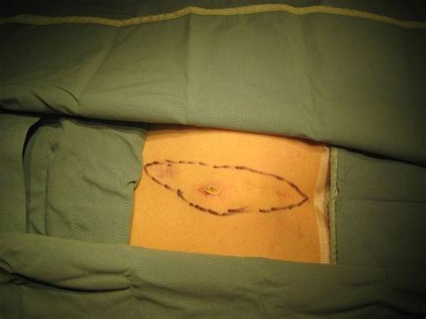 Case 1 Pilonidal Disease Dr Noorali Bharwani