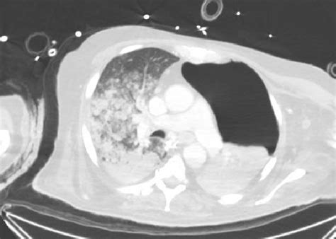 Left Side Pneumothorax Demonstrated By Ct Scan Download Scientific