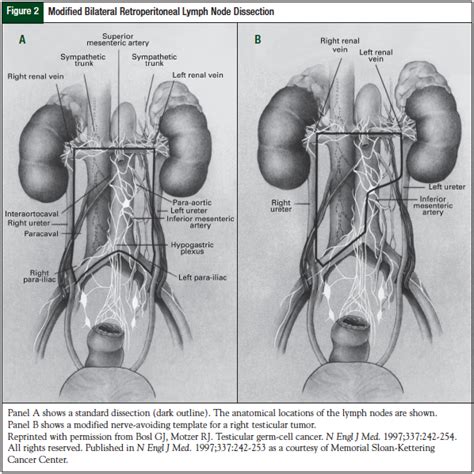Testicular Germ Cell Tumors A History Of “if You Dont Cure The First