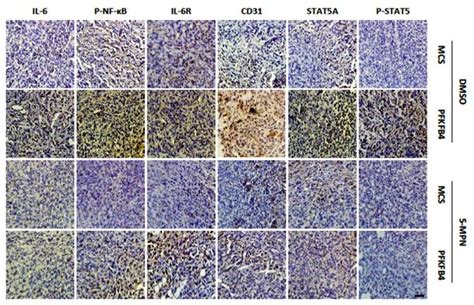 Pfkfb4 Promotes Angiogenesis Via Il 6 Stat5a P Stat5 Signaling In Breast Cancer Erratum