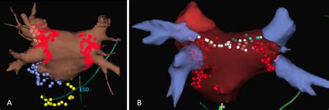 Electroanatomical Mapping With 3d Reconstruction Of The Left Atrium And