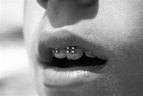 Premium Photo Close Up Of Person With Braces