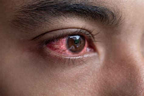 Pink Eye Symptoms Conjunctivitis 11 Most Common Symptoms Of Pink Eye