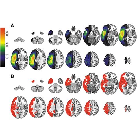 Effect Of Stroke On Contralateral Functional Connectivity Recent