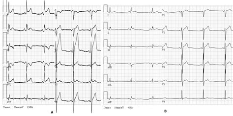 A Ecg Demonstrates Widespread St Segment Elevation St Depression In Download Scientific