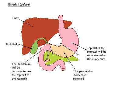 Surgical Procedures For Primary GIST GIST Support International