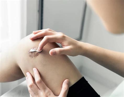 زخم تروما چیست؟ علت و درمان زخم تروماتیک سیکالدرم