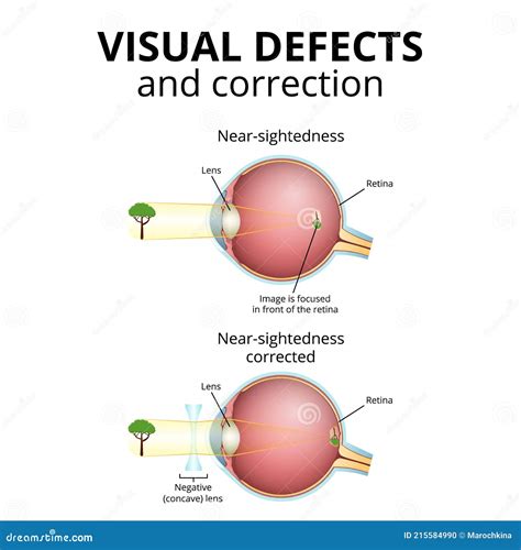 Structure Of The Eyeball Visual Impairment Near Sightedness Stock