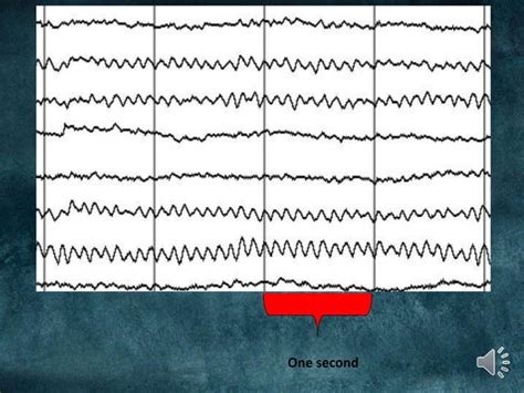 Eeg Basic To Practice 2 Ppt Eeg Basic To Practice 2 Ppt