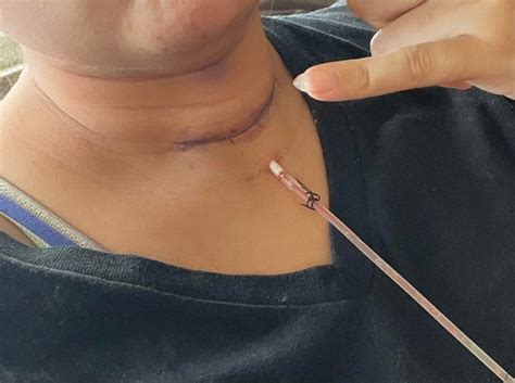 New Memberandpossible Thyroid Cancer R Thyroidcancer