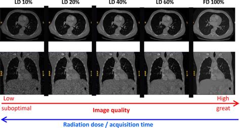 Automated Pulmonary Nodule Classification From Low Dose Ct Images Using Erbnet An Ensemble