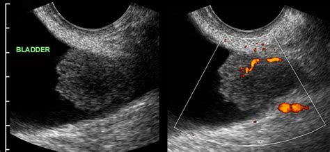 The Radiology Assistant Transvaginal Ultrasound For Non