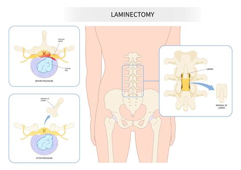 Laminectomy Luke Macyszyn