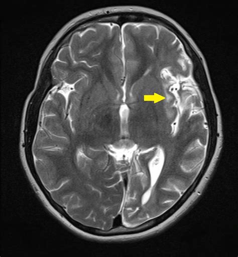 Rasmussens Encephalitis Eurorad