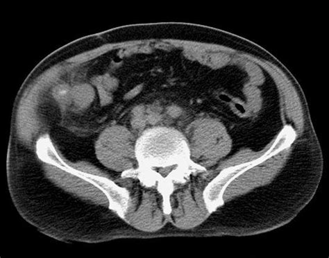 Stump Appendicitis Diagnosed With Preoperative Us And Ct Eurorad