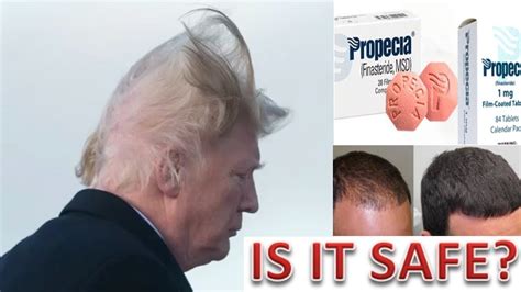 Finasteride One Year Side Effects And Results Is It Safe Youtube