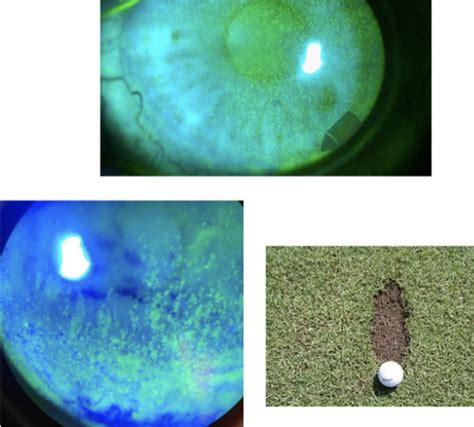 Ocular Disease Fall Od2 Corneal Staining Edema Deposits And Other