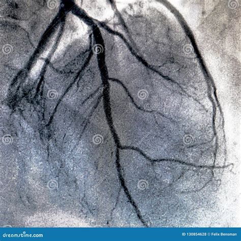 Cardiac Ventriculography Catheterization Royalty Free Stock Image