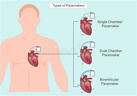 The Different Types Of Pacemakers Stock Vector Illustration Of