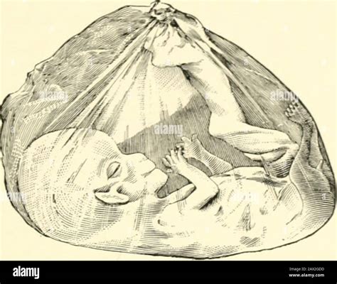 A Textbook Of Obstetrics Fig 154 Thickened Decidua Forming Cast Of