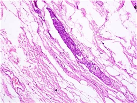 Neural Tissue In Teratoma Download Scientific Diagram