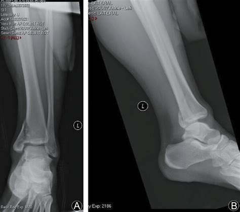 Distal Tibiofibular Joint