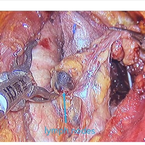 Rates Of Transient And Permanent Hypoparathyroidism In The Reviewed Download Scientific Diagram