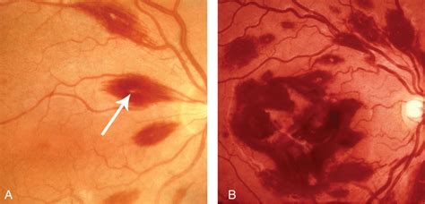 Retinal Vascular Disease Ento Key