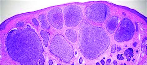 Nests Of Basaloid Cells In The Dermis With Hyperchromatic Nuclei And A Download Scientific