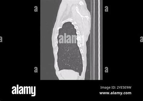 Side View Chest Ct Stock Videos And Footage Hd And 4k Video Clips Alamy