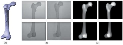 A Deformed 3 D Model In Which The Deformation Of The Anteversion Download Scientific Diagram