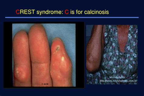 Crest Syndrome