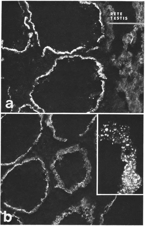 Immunofluorescence Photomicrographs Showing Massive Diffuse Granular