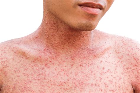 Smallpox Facts Causes Symptoms Transmission Prevention FactDr
