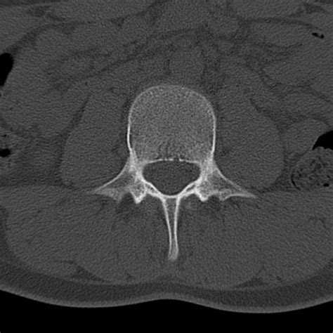 Bilateral Pars Defect Radiopaedia 26691 26846 Axial Bone Window Nc Commons