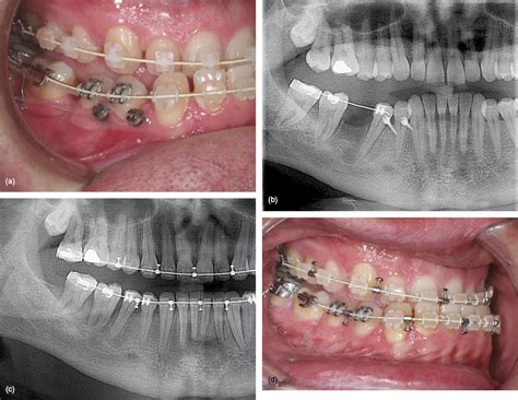 Molar Protraction Pocket Dentistry