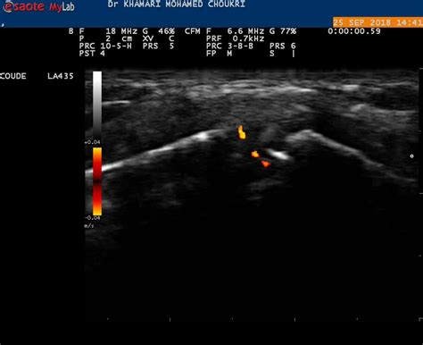 Mohamed Choukri Khamari On Linkedin Arthritis Of The Manubriosternal Joint In Course Of A