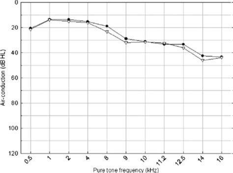 Mean Hearing Thresholds Air Conduction In Db Hl Of All Patients With