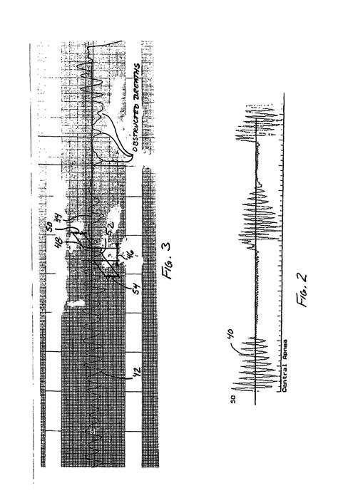 Airway Obstruction Patented Technology Retrieval Search Results