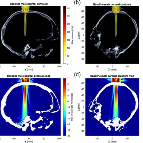 Skull Base Effects In The Baseline Female Skull Pressure Maps Download Scientific Diagram