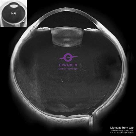 To Edit A “whole Eye” Oct Image Has Always Been In My To Do List For Years However Excessive