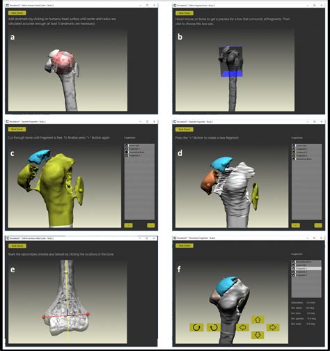 Subsequent Steps Towards Anatomic Fracture Reduction Of A Proximal Download Scientific Diagram